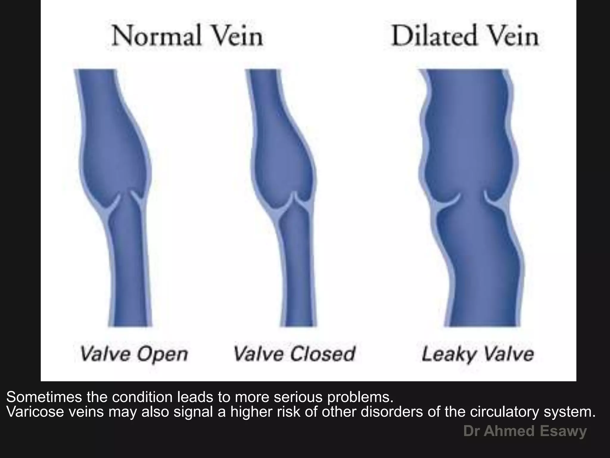 4 peripheral venous duplex pt 4 varices dr ahmed esawy | PPTX