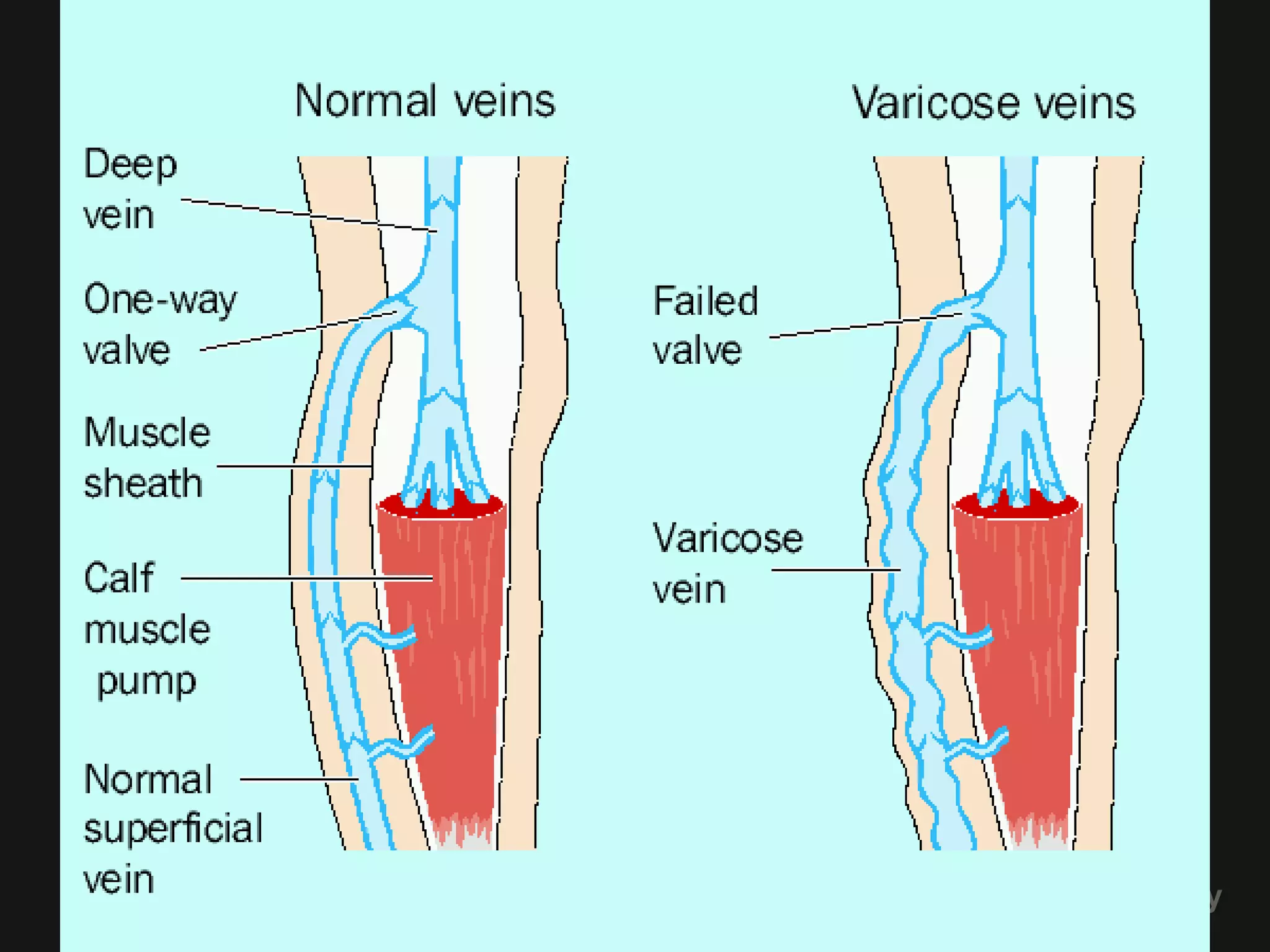4 peripheral venous duplex pt 4 varices dr ahmed esawy | PPTX