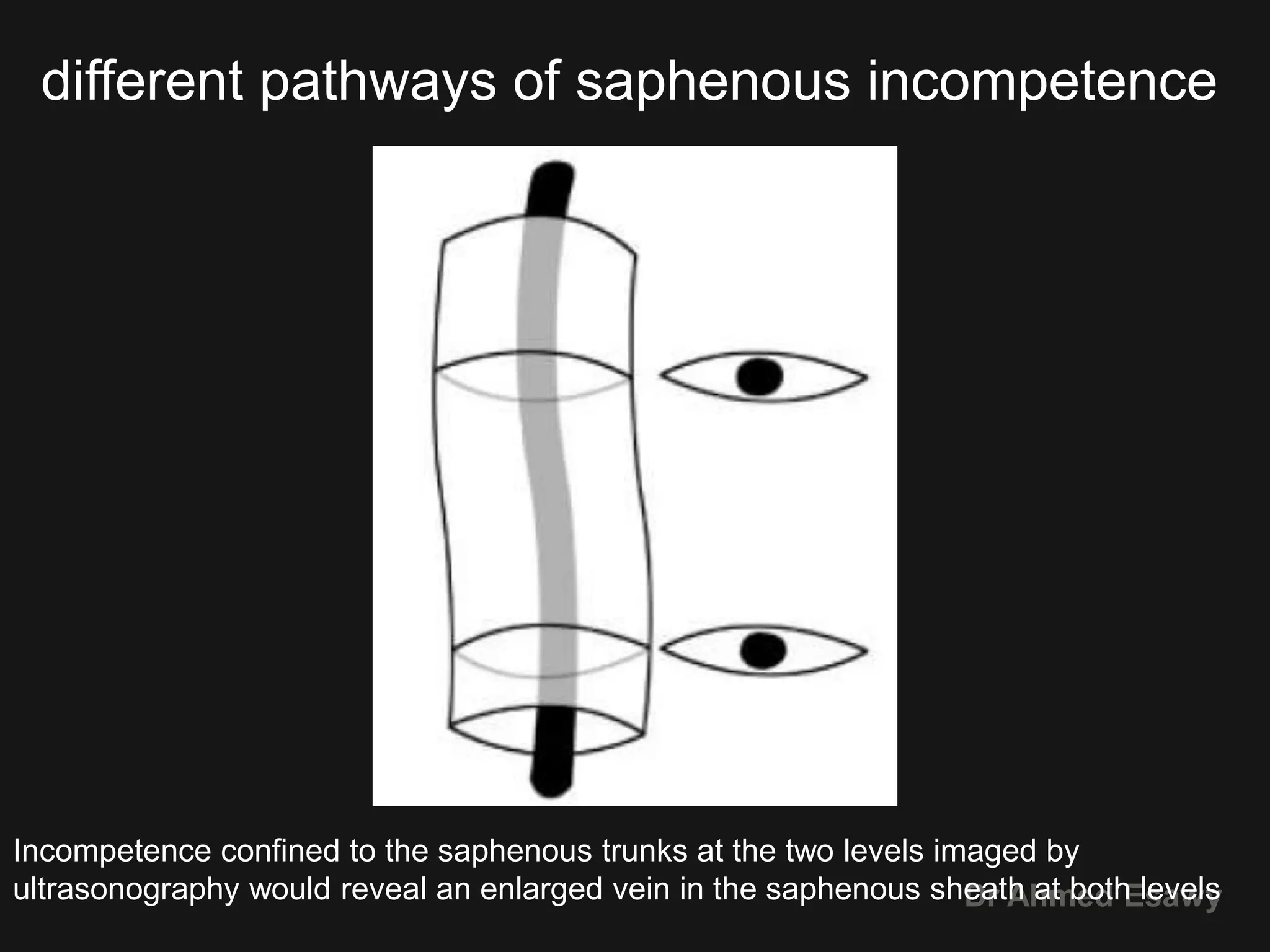 4 peripheral venous duplex pt 4 varices dr ahmed esawy | PPTX