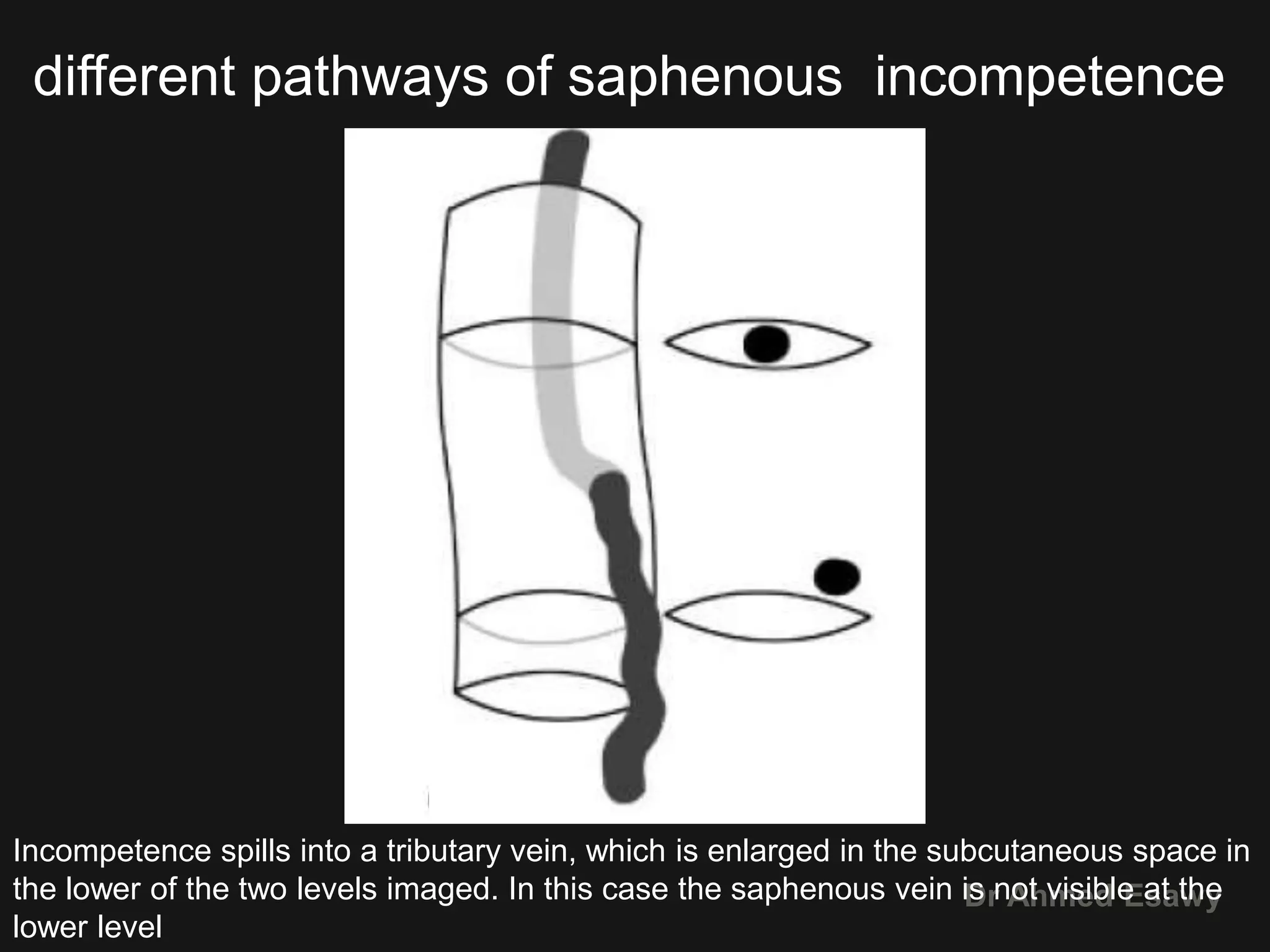 4 peripheral venous duplex pt 4 varices dr ahmed esawy | PPTX