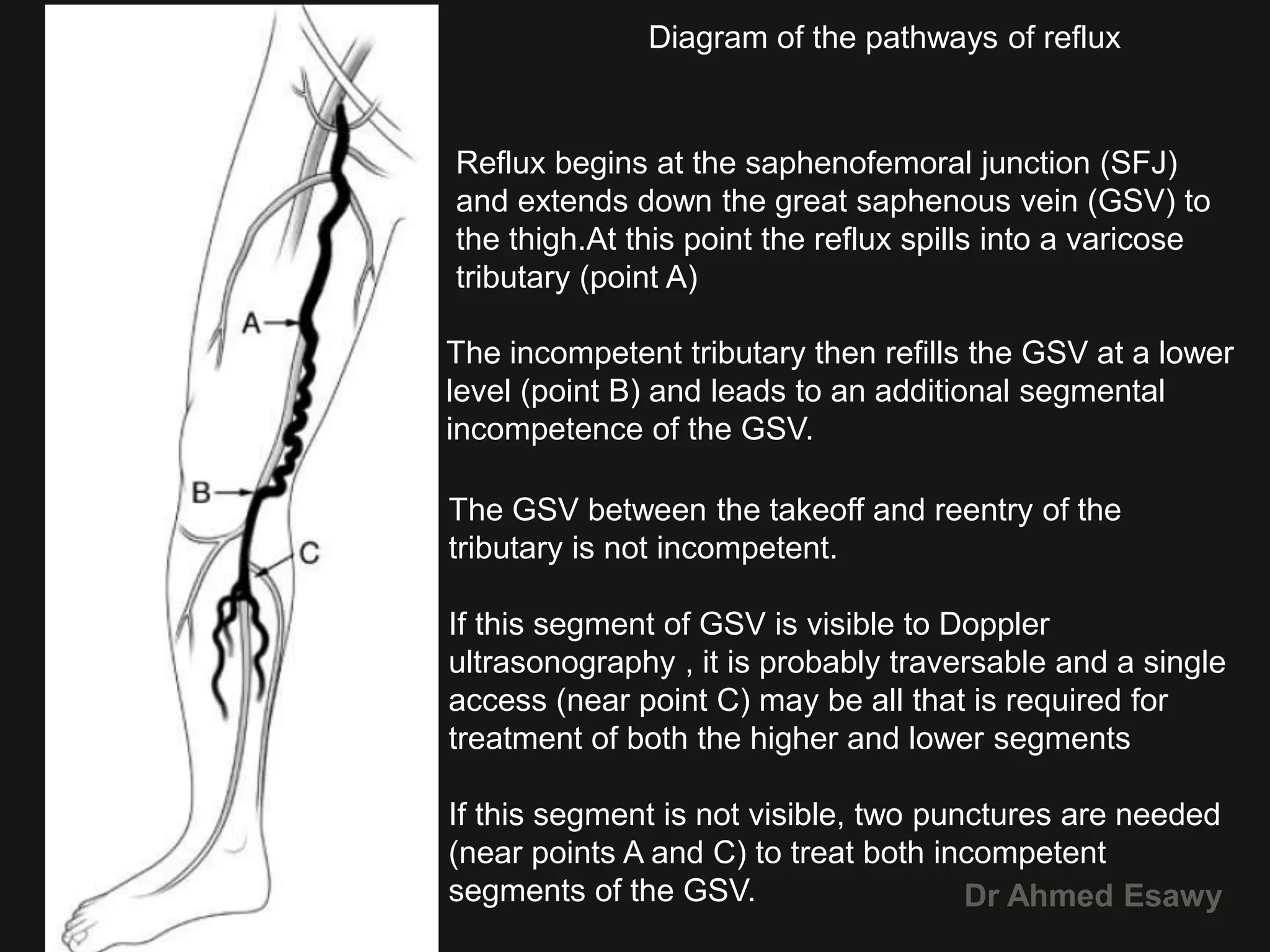 4 peripheral venous duplex pt 4 varices dr ahmed esawy | PPTX