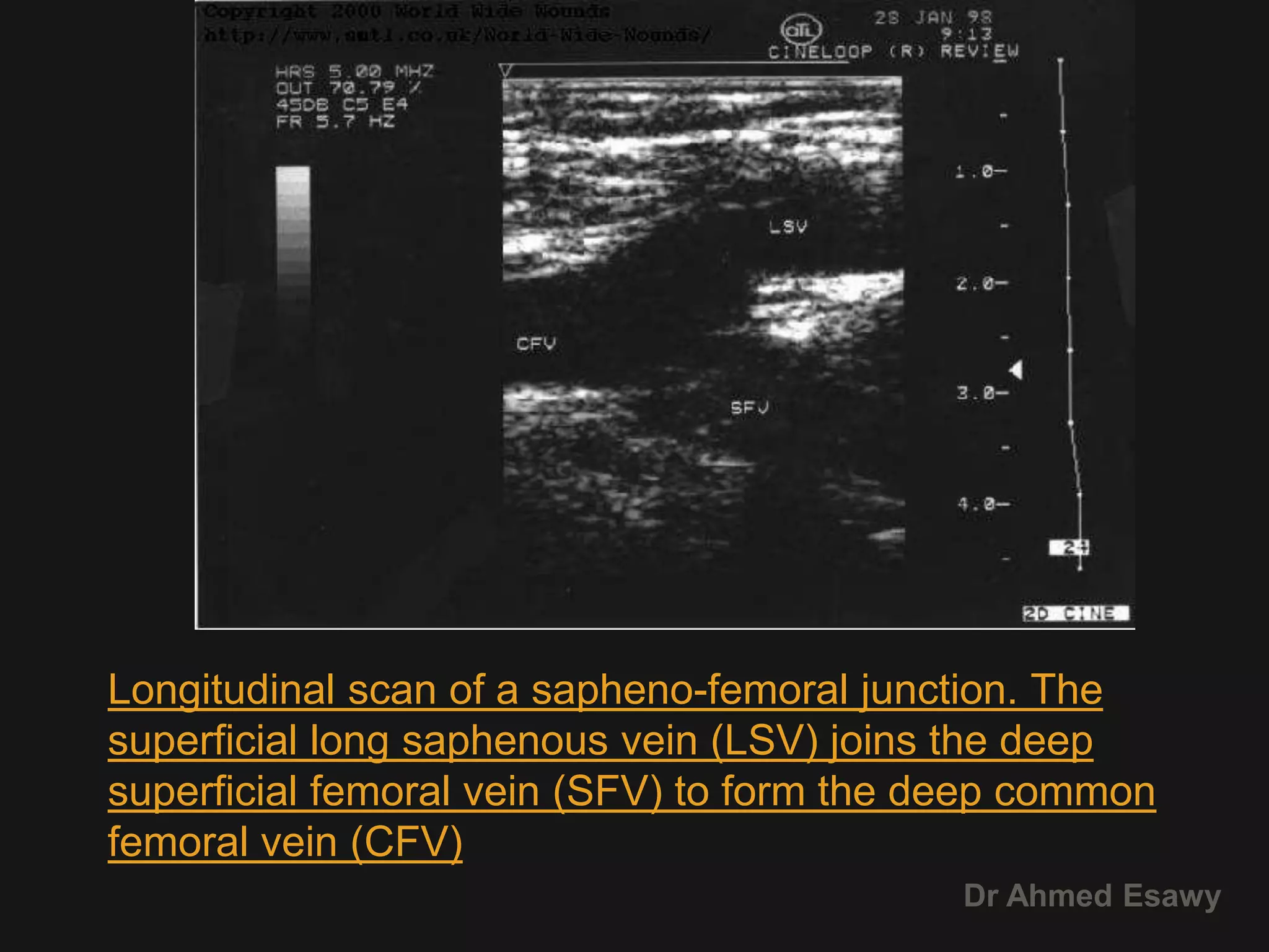 4 peripheral venous duplex pt 4 varices dr ahmed esawy | PPTX