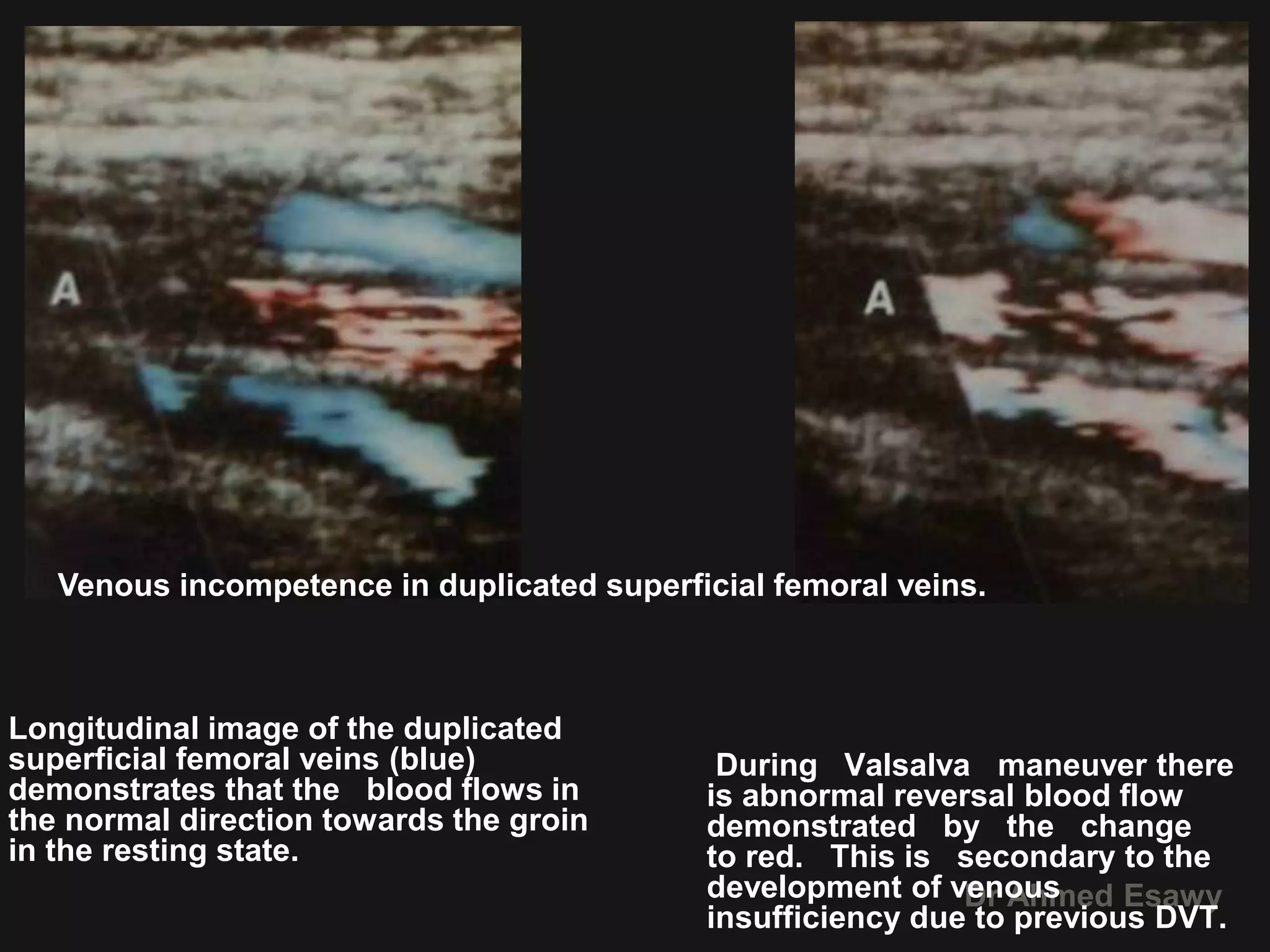 4 peripheral venous duplex pt 4 varices dr ahmed esawy | PPTX