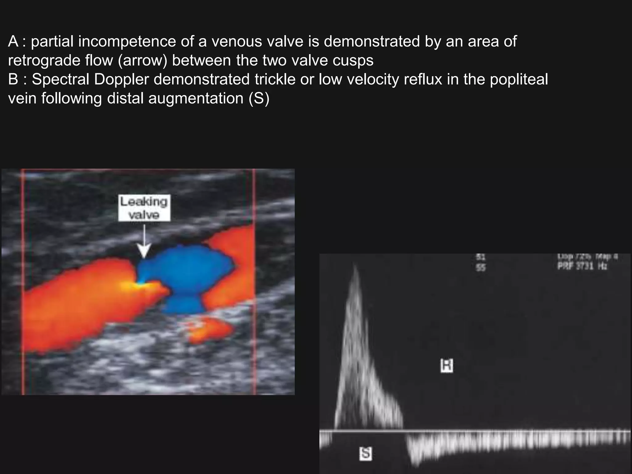 4 peripheral venous duplex pt 4 varices dr ahmed esawy | PPTX