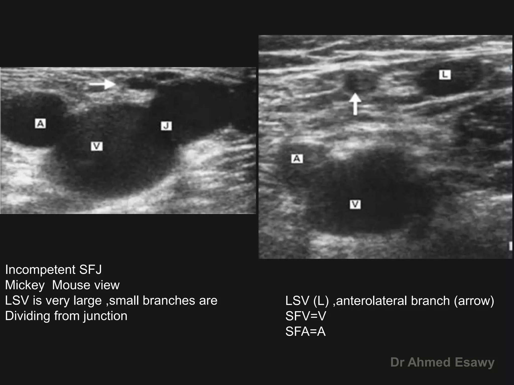 4 peripheral venous duplex pt 4 varices dr ahmed esawy | PPTX