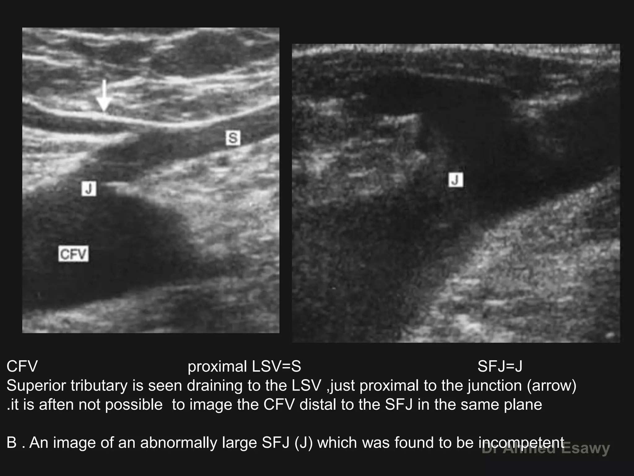 4 peripheral venous duplex pt 4 varices dr ahmed esawy | PPTX