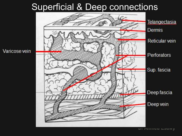 4 peripheral venous duplex pt 4 varices dr ahmed esawy | PPTX