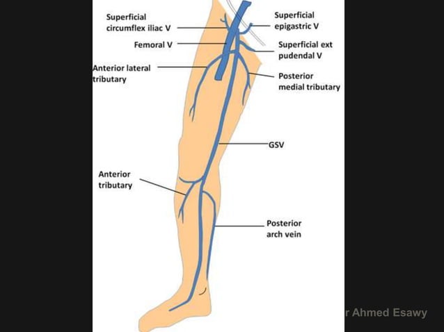 4 peripheral venous duplex pt 4 varices dr ahmed esawy | PPTX