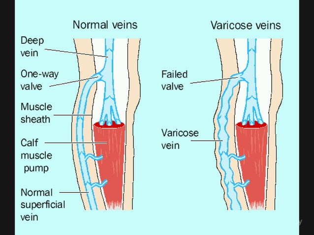 4 peripheral venous duplex pt 4 varices dr ahmed esawy | PPT | Free ...