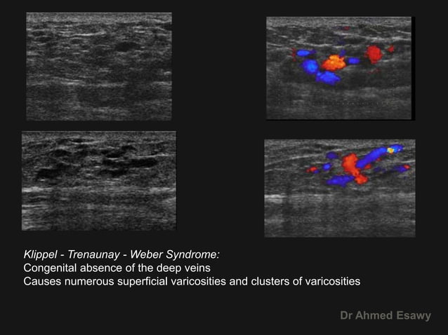 4 peripheral venous duplex pt 4 varices dr ahmed esawy | PPTX