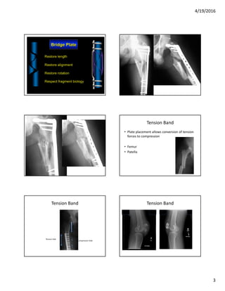 4 plate-biomechanics | PDF