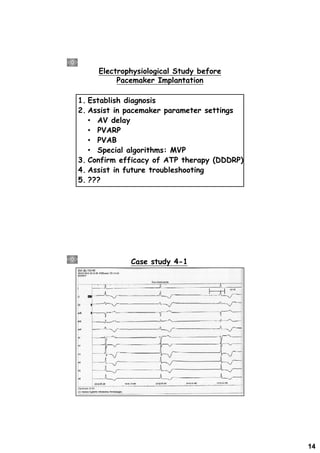 Electrophysiologic Study for Pacemaker Implantation | PDF