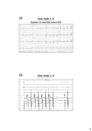 Electrophysiologic Study for Pacemaker Implantation | PDF