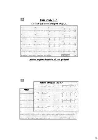 Electrophysiologic Study for Pacemaker Implantation | PDF