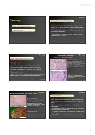 4.Pulmonary Tuberculosis | PDF