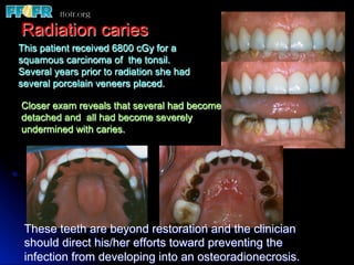 4.radiation effects – salivary glands, bone and teeth | PPT