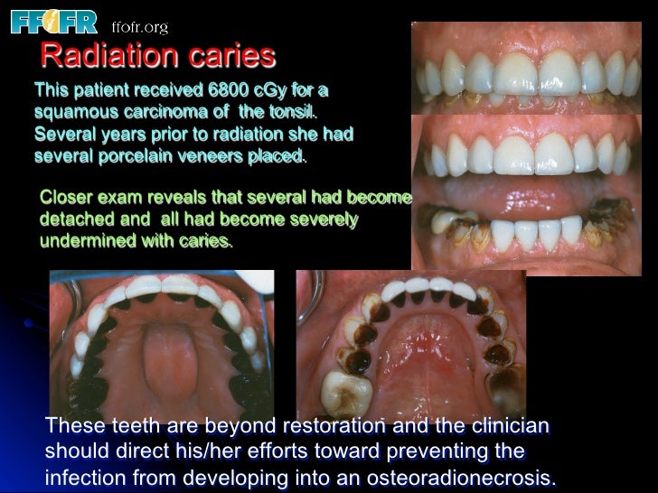 4.radiation effects – salivary glands, bone and teeth