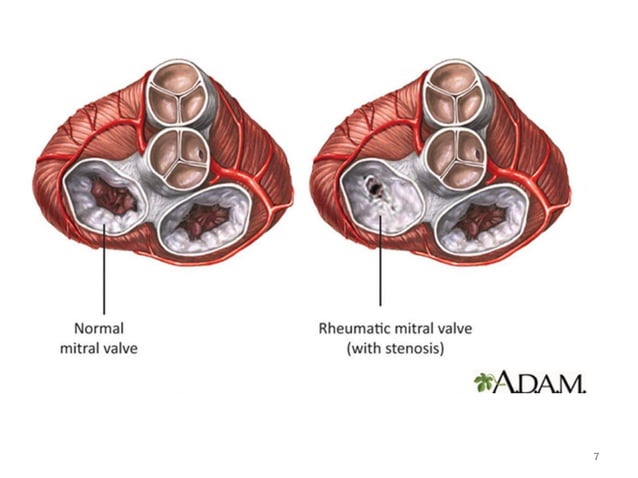 4- RHD IE rhumatic heart disease 222.pdf