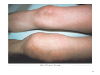 4- RHD IE rhumatic heart disease 222.pdf