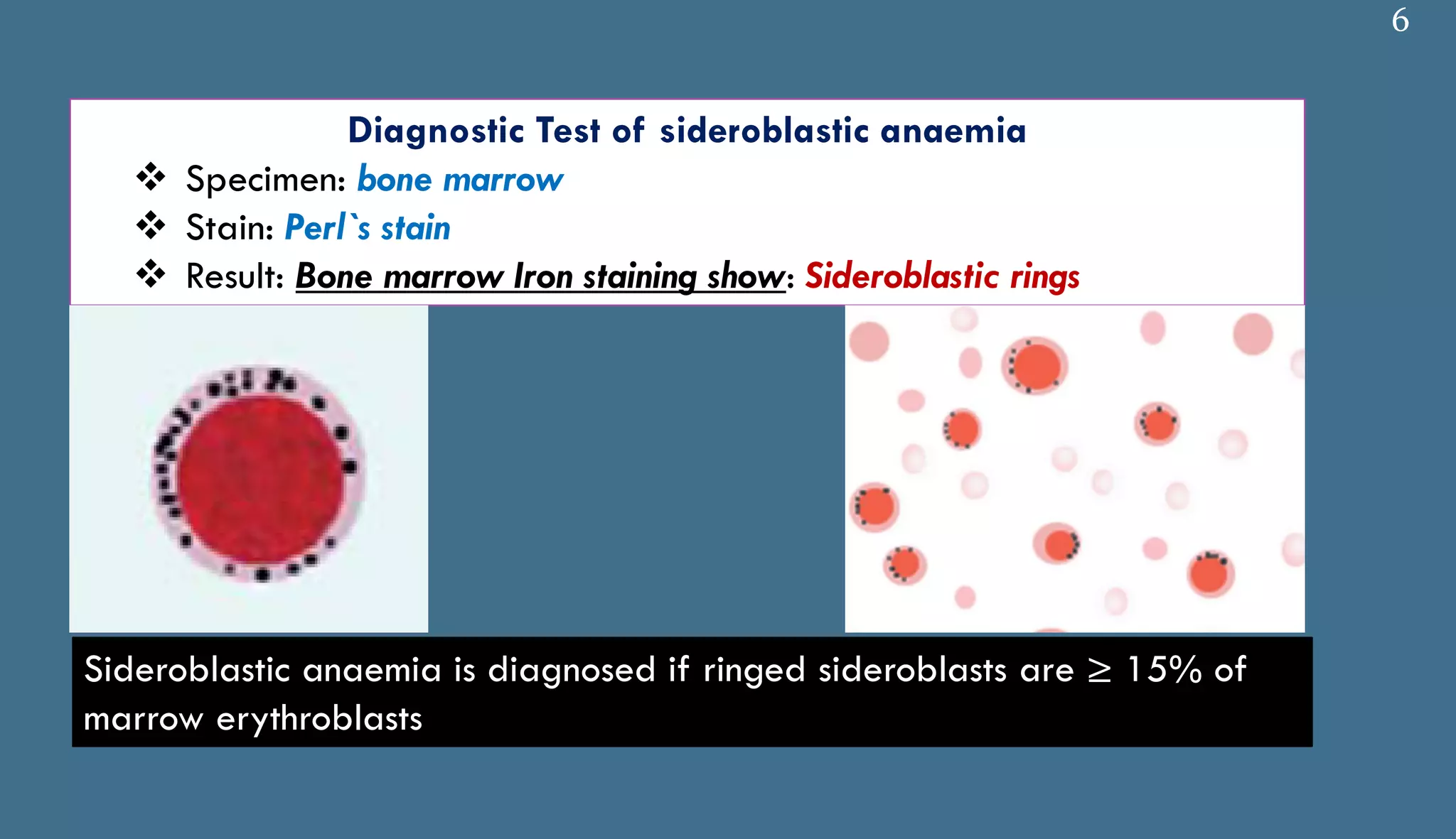 Sederoblastic anemia | PDF