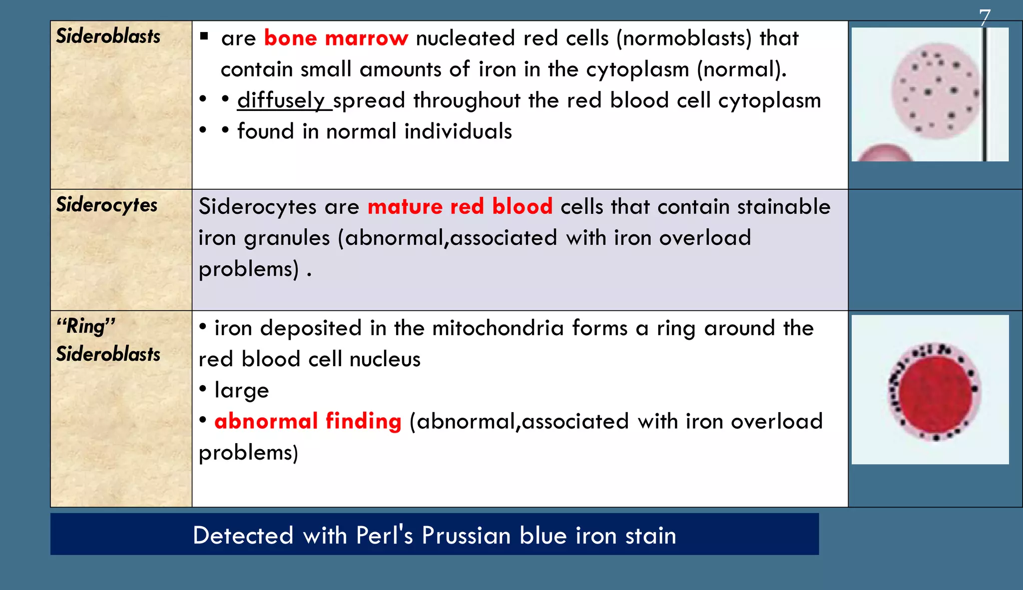 Sederoblastic anemia | PDF