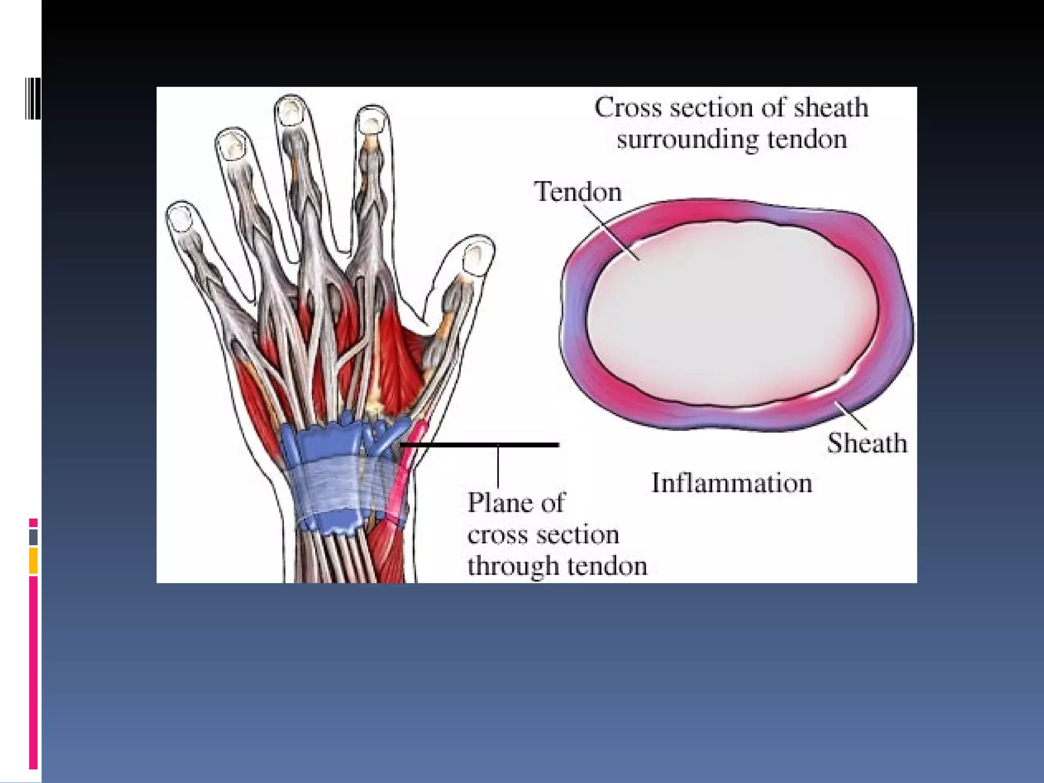 4. spaces of the hand & its applied anatomy[1] | PPT