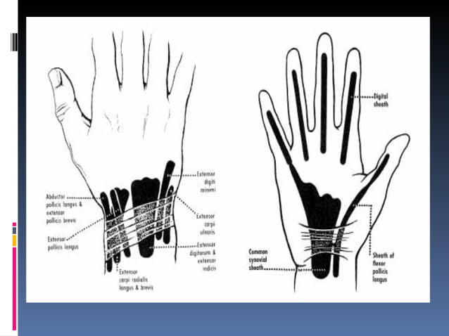 4. spaces of the hand & its applied anatomy[1] | PPT
