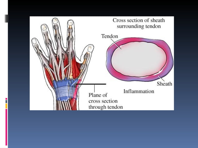 4. spaces of the hand & its applied anatomy[1] | PPT