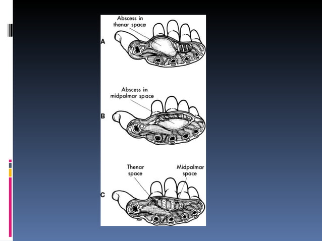 4. spaces of the hand & its applied anatomy[1] | PPT