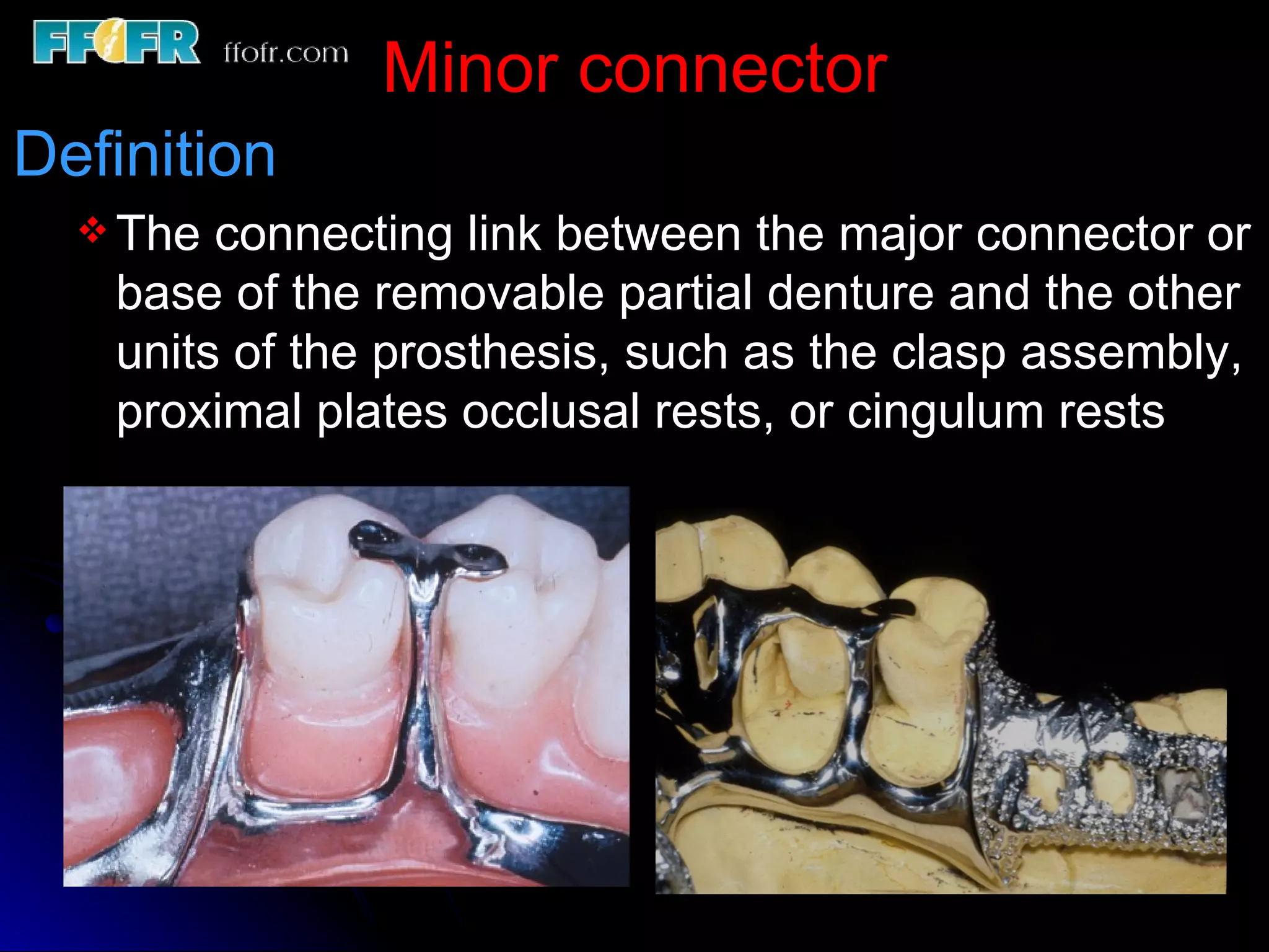 4.the tooth tissue junction, major and minor connectors | PPT