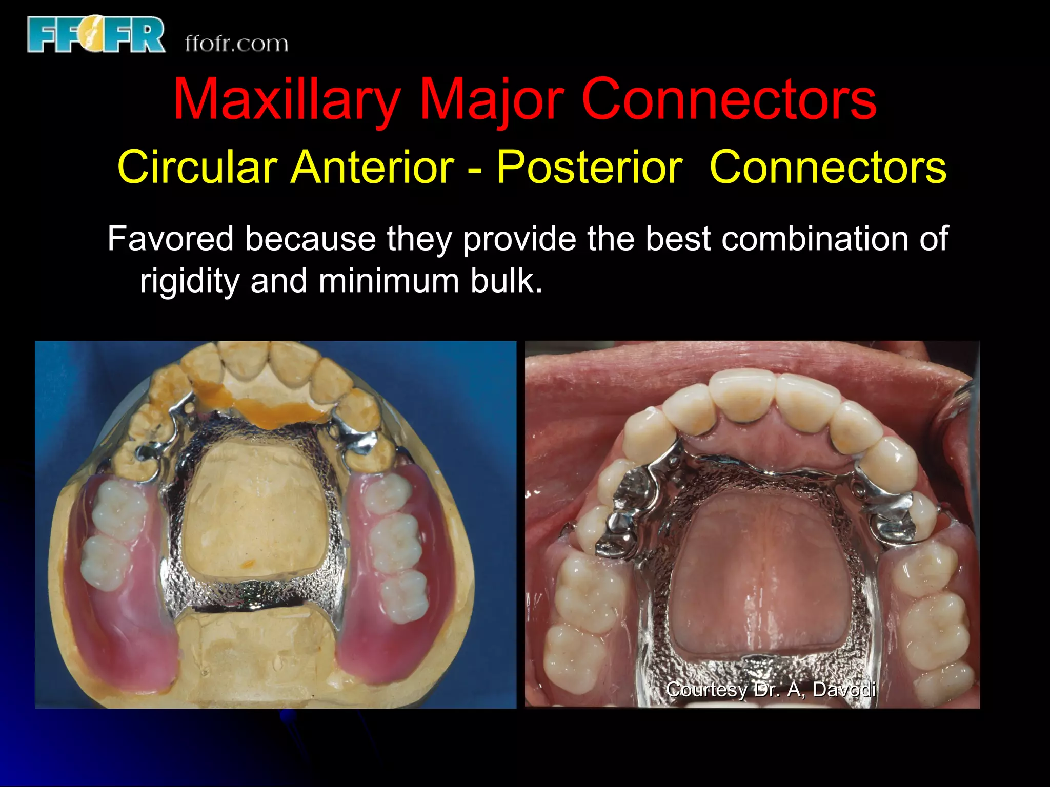 4.the tooth tissue junction, major and minor connectors | PPT