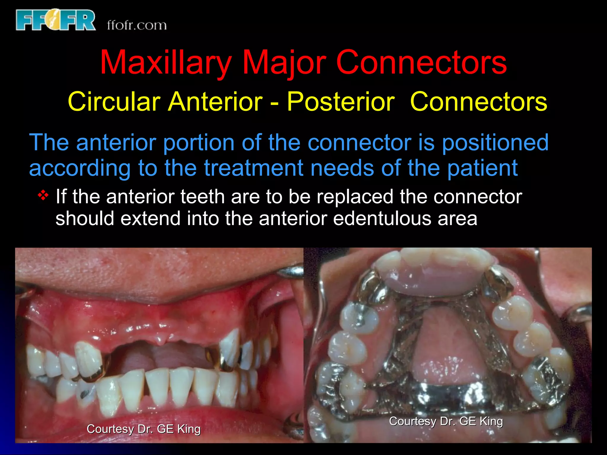 4.the tooth tissue junction, major and minor connectors | PPT