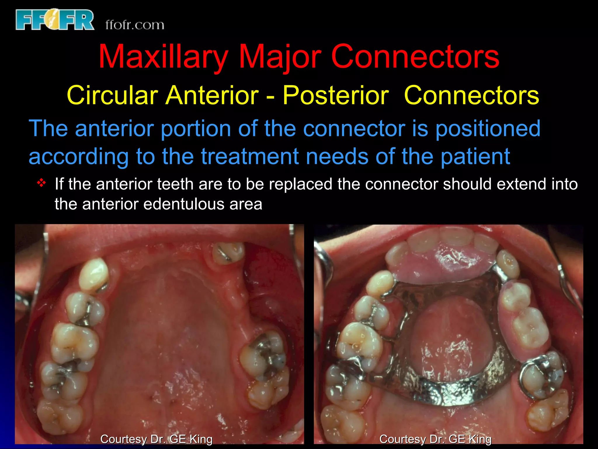4.the tooth tissue junction, major and minor connectors | PPT