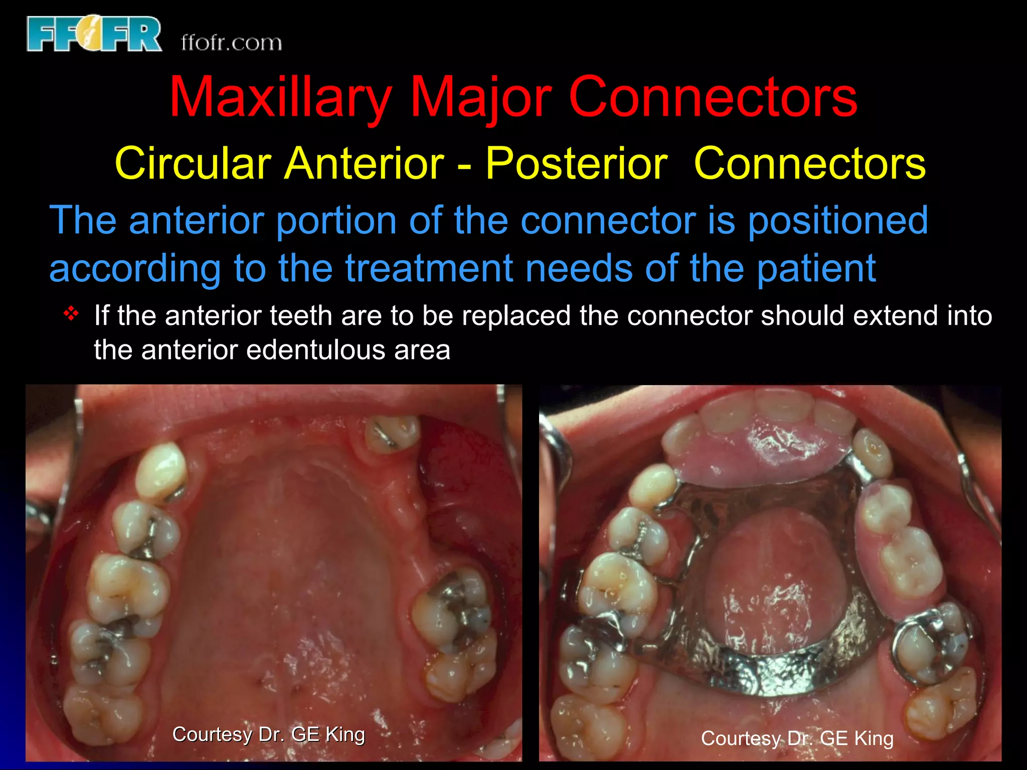 4.the tooth tissue junction, major and minor connectors | PPT | Dental ...