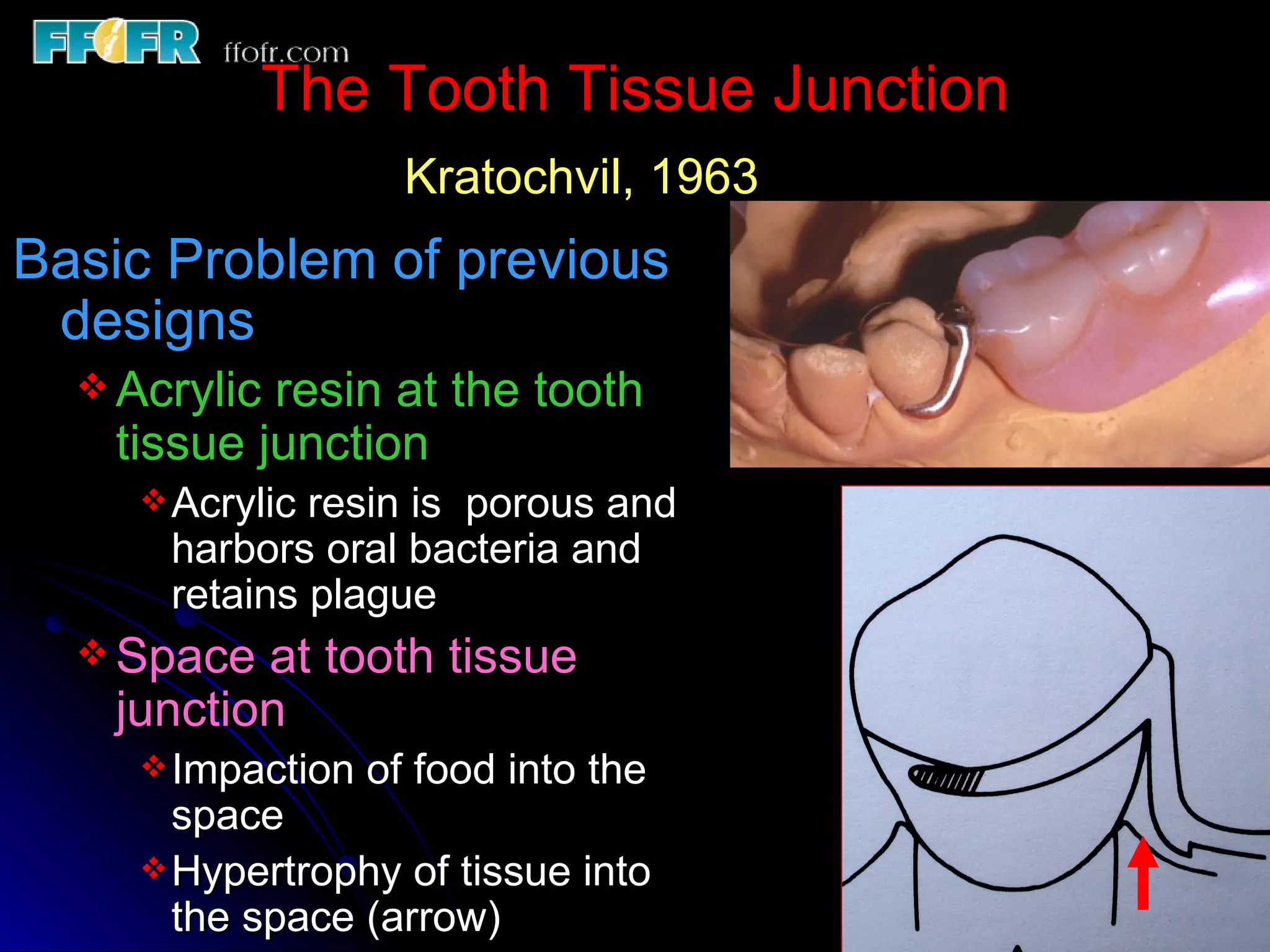 4.the tooth tissue junction, major and minor connectors | PPT