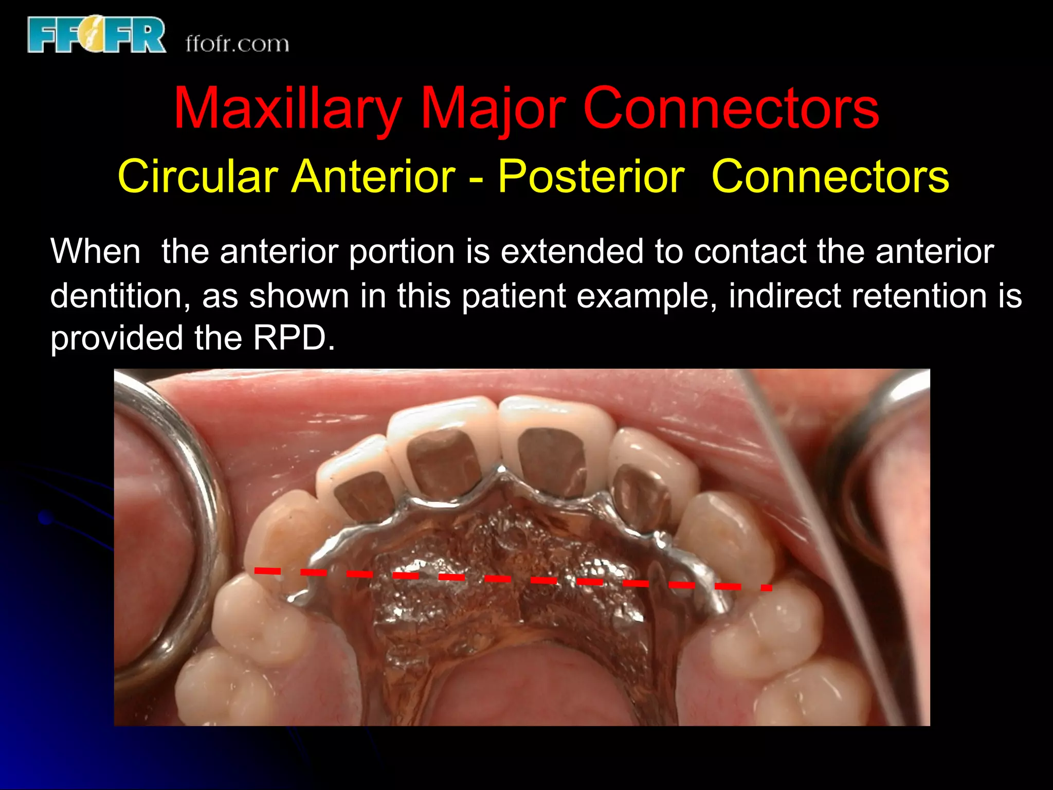 4.the tooth tissue junction, major and minor connectors | PPT