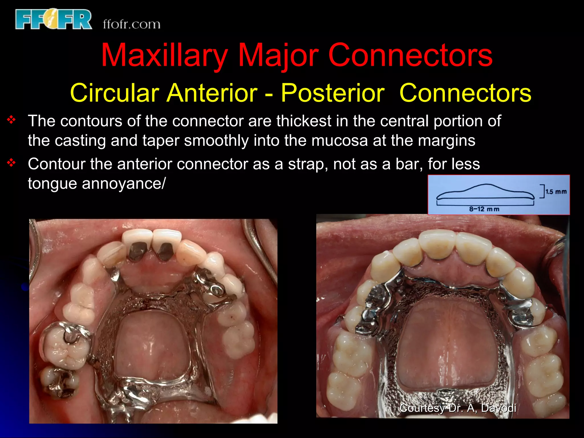 4.the tooth tissue junction, major and minor connectors | PPT