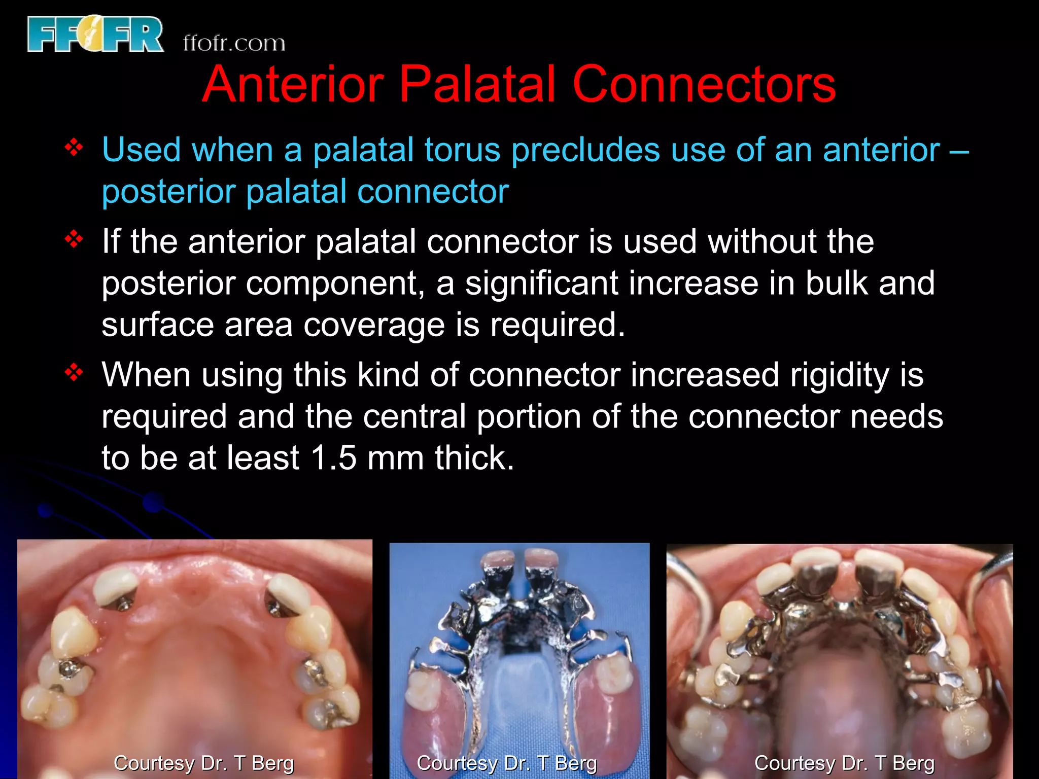 4.the tooth tissue junction, major and minor connectors | PPT