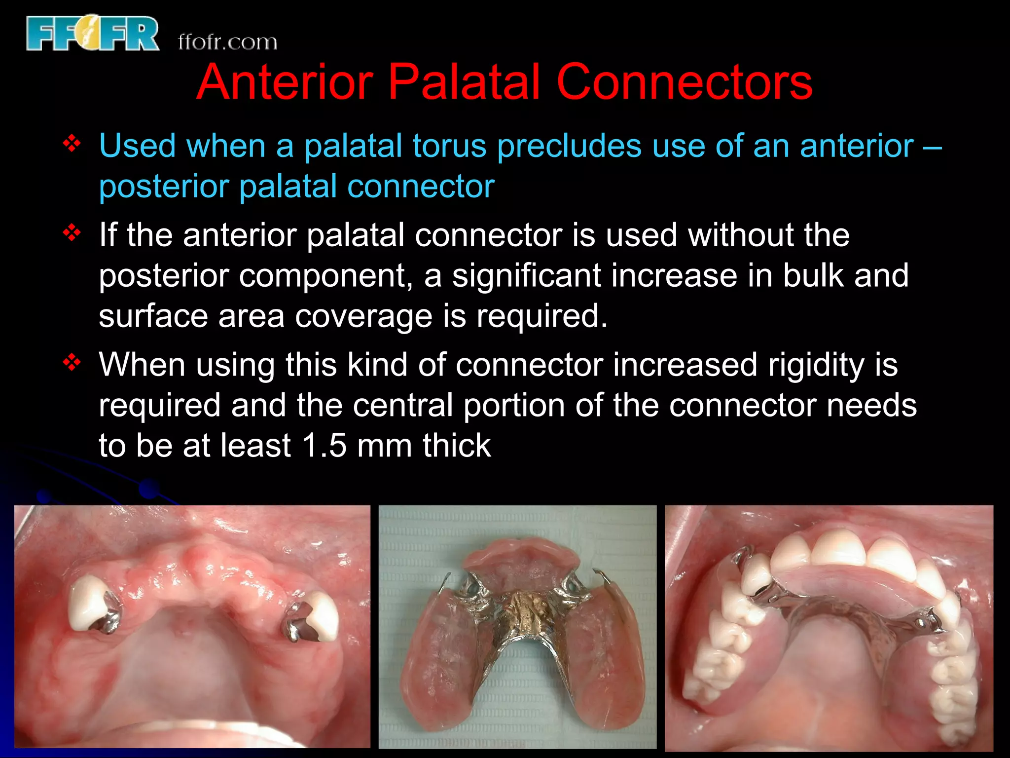 4.the tooth tissue junction, major and minor connectors | PPT