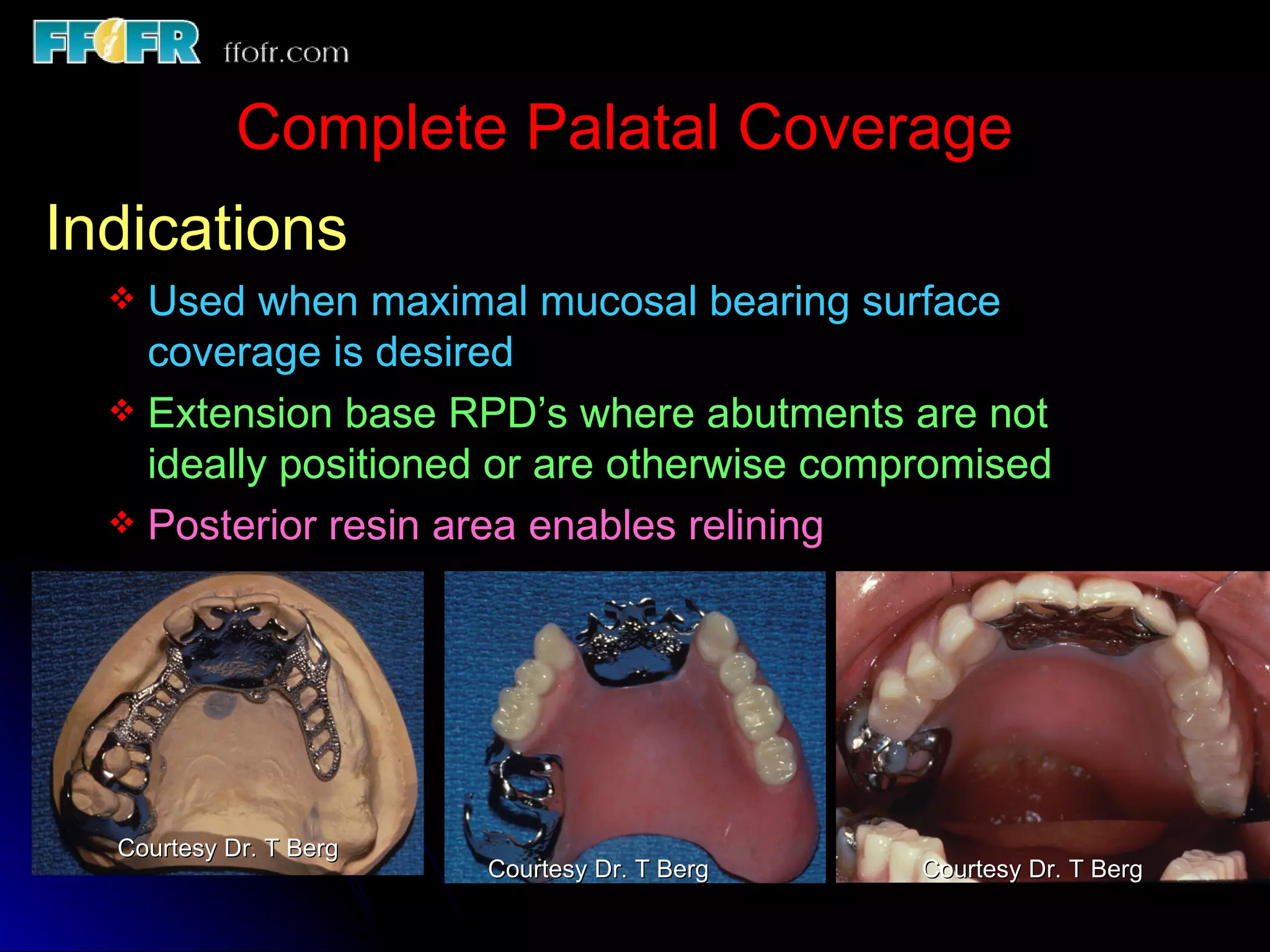 4.the tooth tissue junction, major and minor connectors | PPT