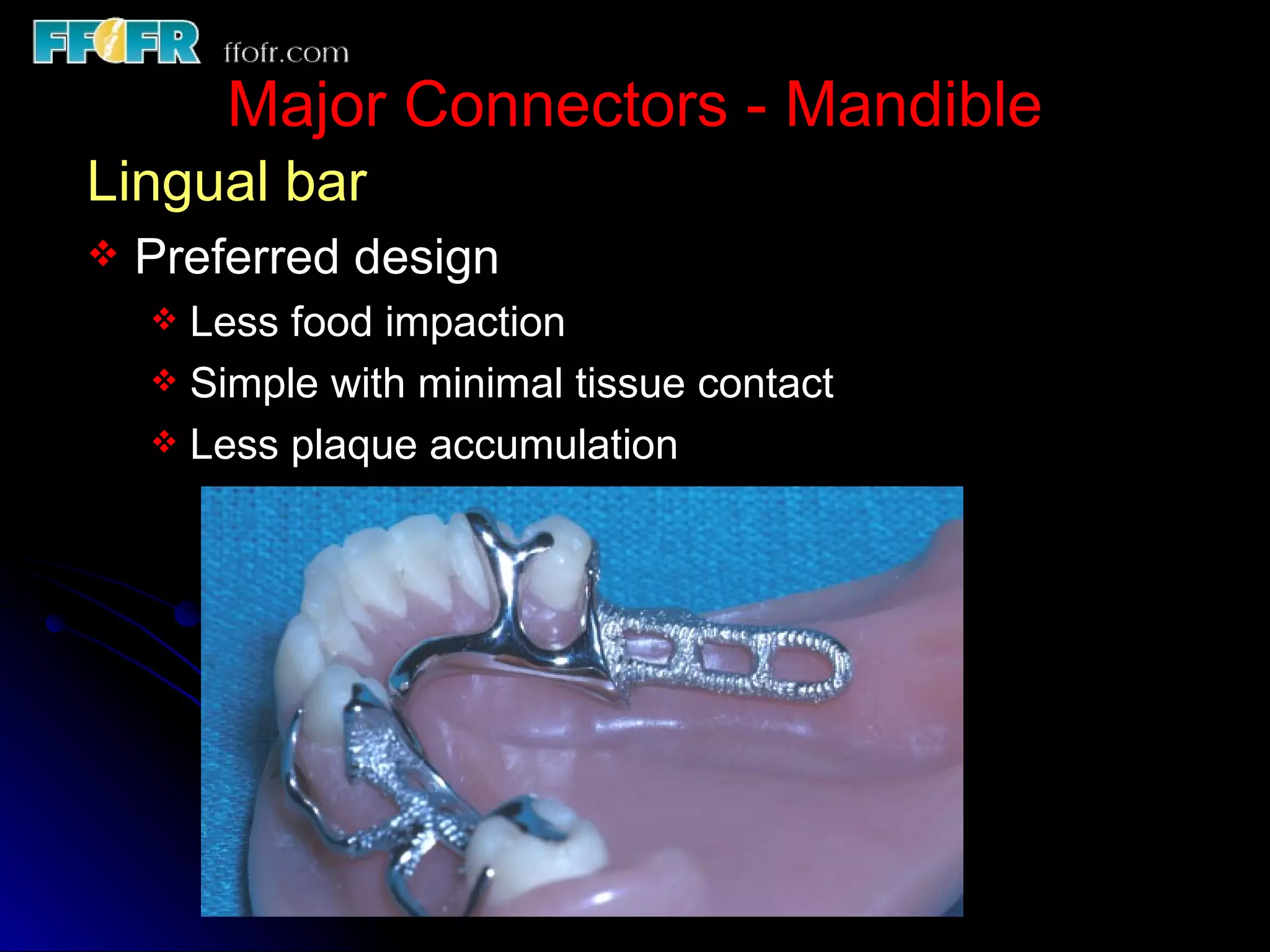 4.the tooth tissue junction, major and minor connectors | PPT