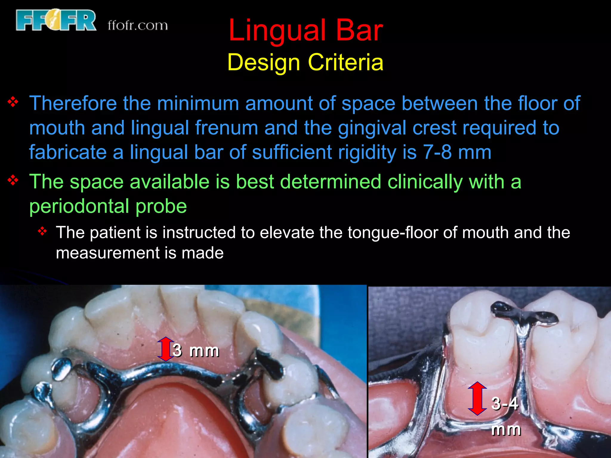 4.the tooth tissue junction, major and minor connectors | PPT | Dental ...