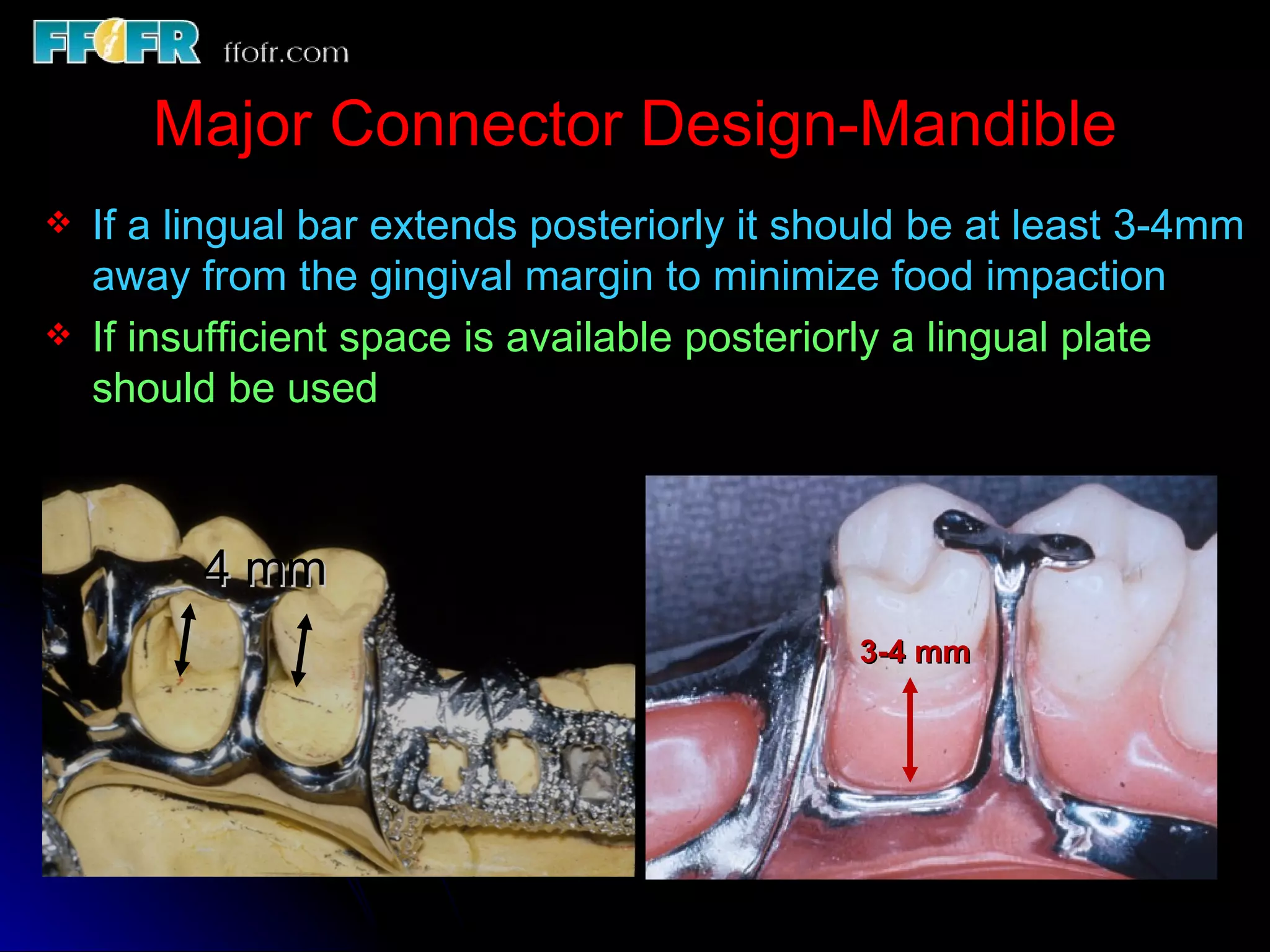 4.the tooth tissue junction, major and minor connectors | PPT