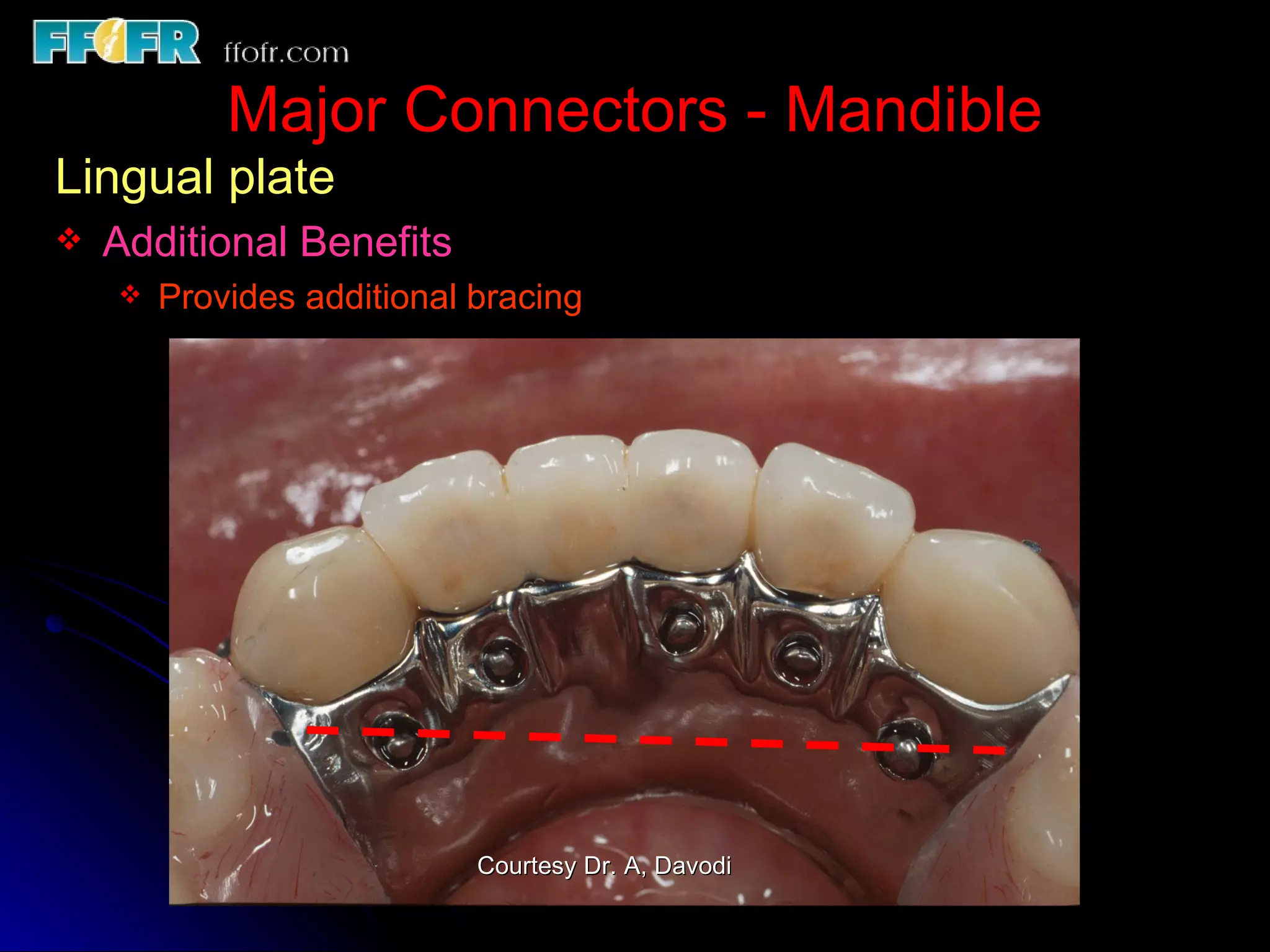 4.the tooth tissue junction, major and minor connectors | PPT