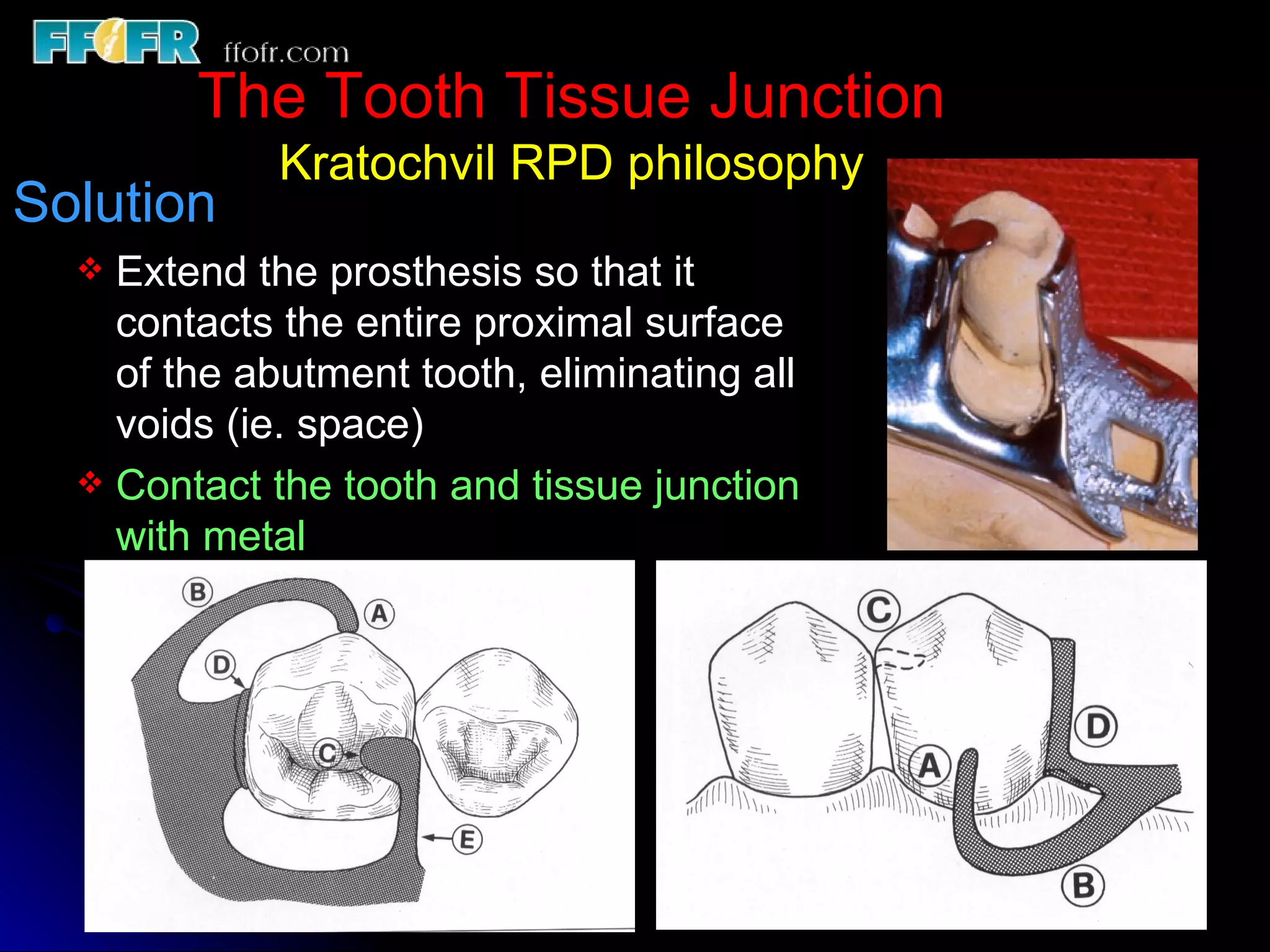 4.the tooth tissue junction, major and minor connectors | PPT