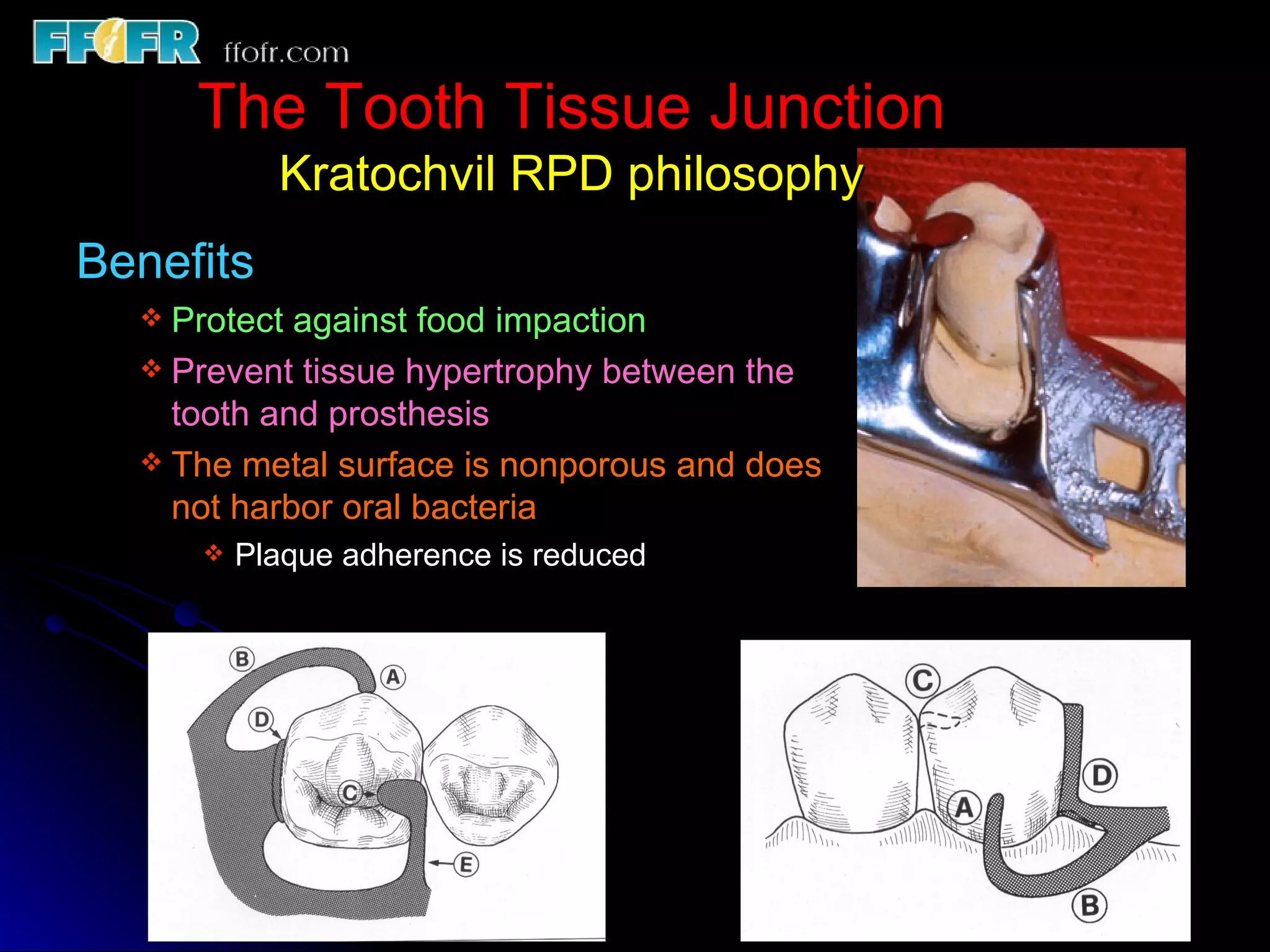 4.the tooth tissue junction, major and minor connectors | PPT
