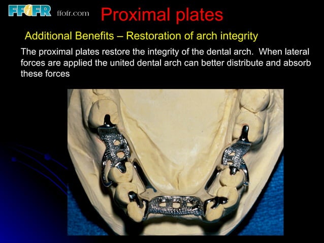 4.the tooth tissue junction, major and minor connectors | PPT | Dental ...