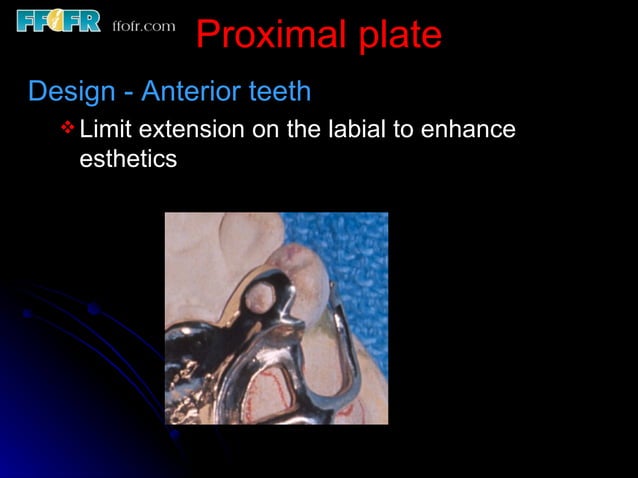 4.the tooth tissue junction, major and minor connectors | PPT | Dental ...