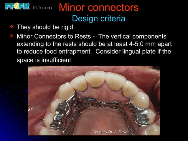 4.the tooth tissue junction, major and minor connectors | PPT | Dental ...