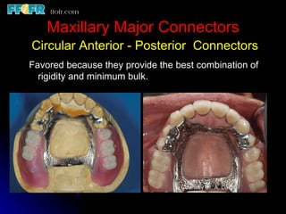 4.the tooth tissue junction, major and minor connectors | PPT